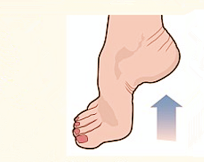 Best Exercises for Fallen Arches to Help You Recover - enkimd